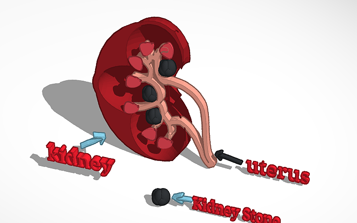 3D design kidney stone model - Tinkercad
